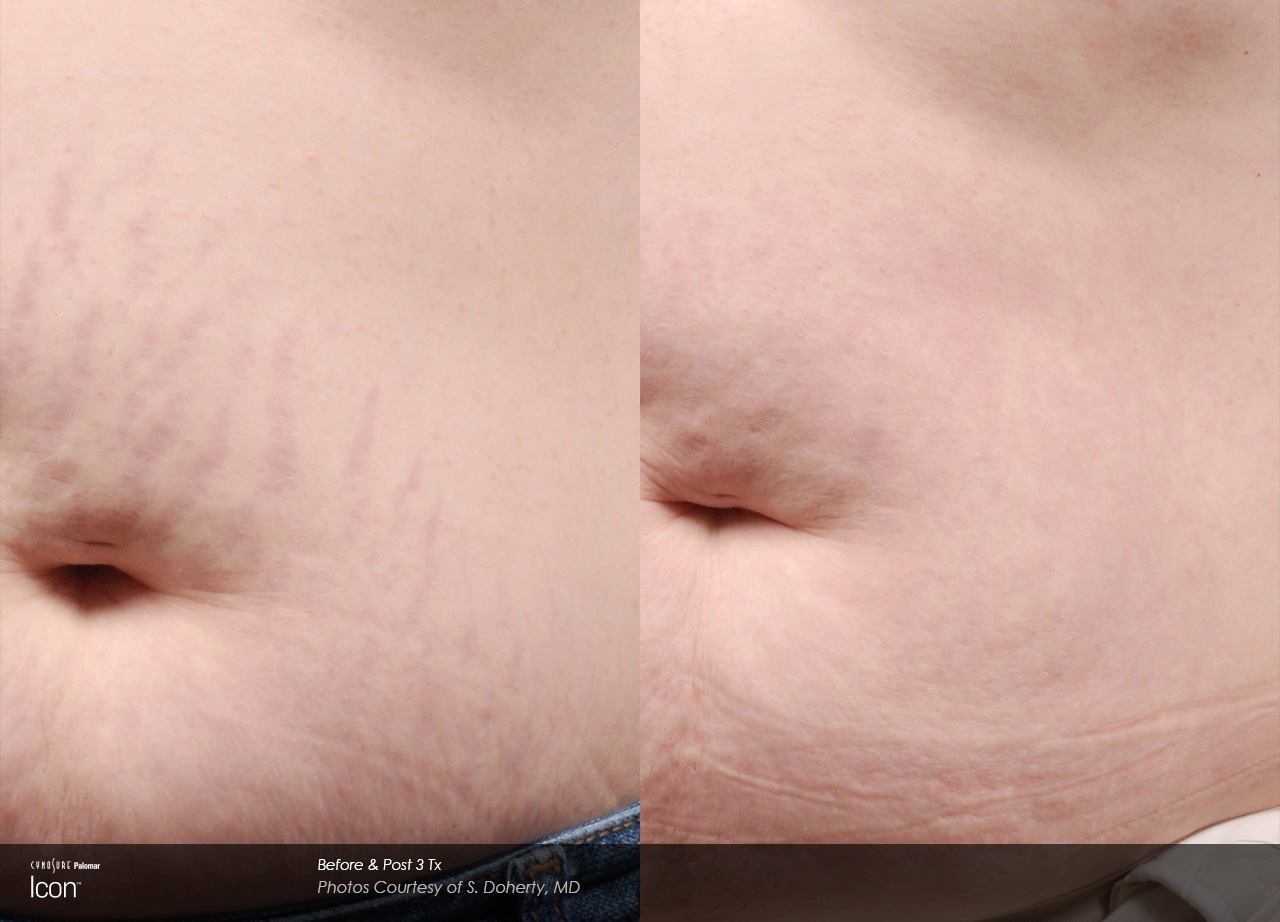 Stretch Mark Reduction Eugene OR | Laser Services | Tone Stretch Marks