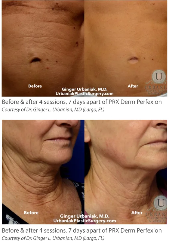 PRX Derm Perfexion Eugene OR | Non-invasive Treatment, Cascade ...