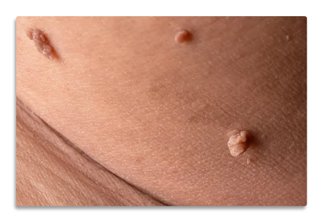 Dermatology Decoded: Skin Tags, Milia, and Other Benign Skin Lesions