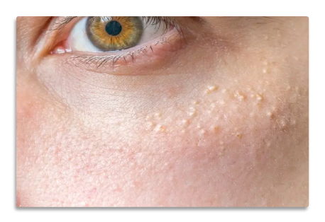 Dermatology Decoded: Skin Tags, Milia, and Other Benign Skin Lesions