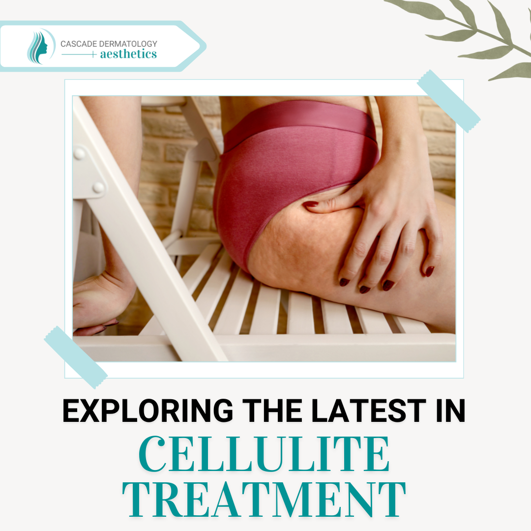 Exploring the Latest in Cellulite Treatment for Firm, Smooth Skin